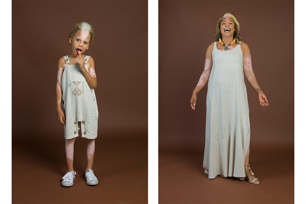 Piebaldism: A Family Trait And A Reason To Learn To Love Oneself ...