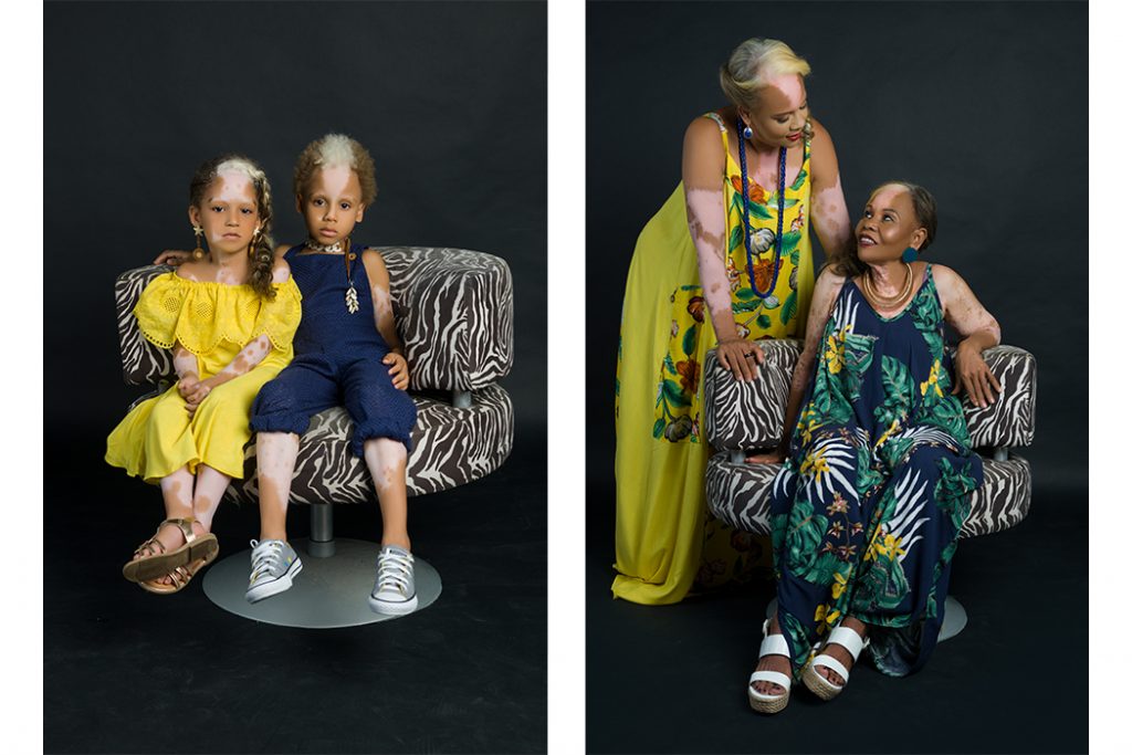 Piebaldism: A Family Trait And A Reason To Learn To Love Oneself ...