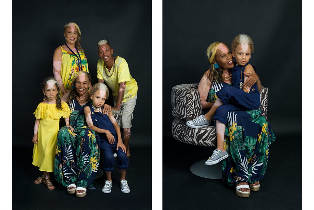 Piebaldism: A Family Trait And A Reason To Learn To Love Oneself ...