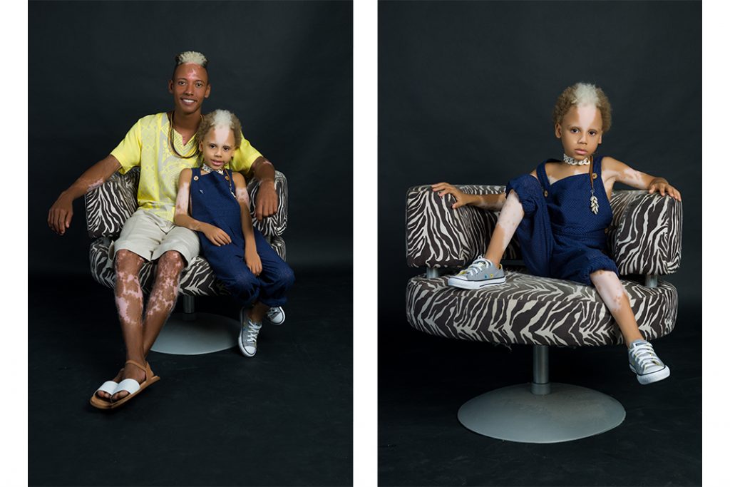 Piebaldism: A Family Trait And A Reason To Learn To Love Oneself ...