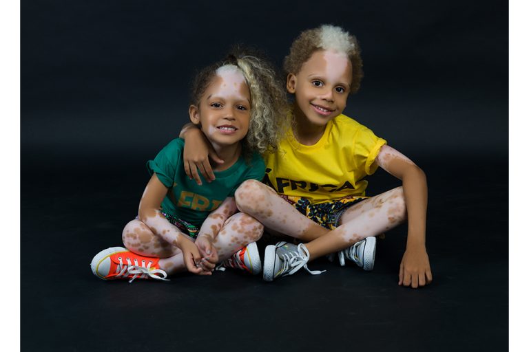 Piebaldism: A Family Trait And A Reason To Learn To Love Oneself ...